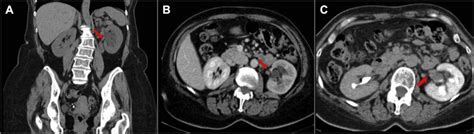 Image result for Delayed Phase CT Urogram
