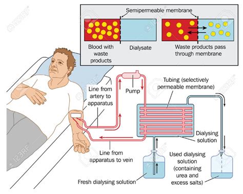 Image result for How Does a Dialysis Machine Work