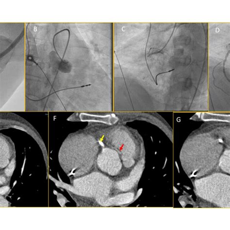 Image result for Radial Loop Angiogram