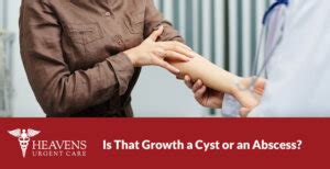 Image result for Exploding Cyst and Abscess