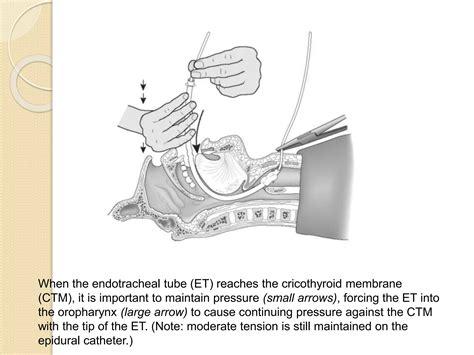 Image result for Retrograde Intubation