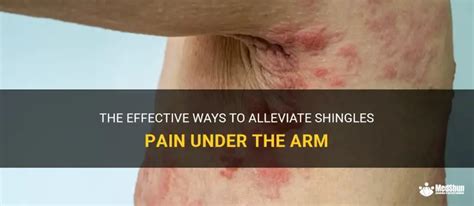 Image result for Shingles On Arm