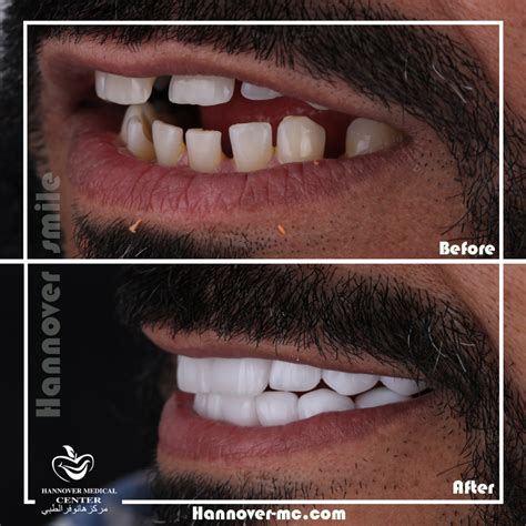 Image result for Surgical Tooth Extraction