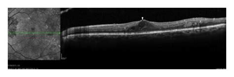 Image result for Oct Line Scan