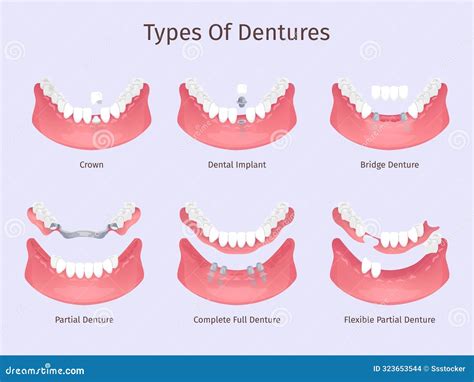 Image result for Denture Types