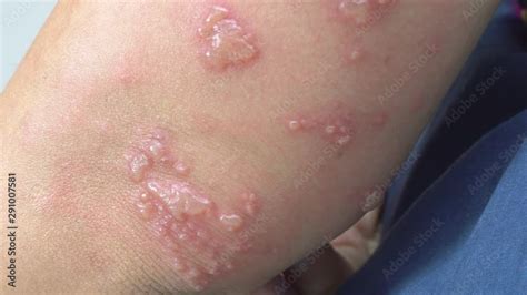 Image result for Shingles On Arm