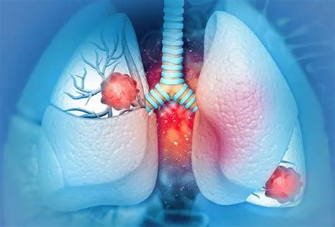 Image result for How Fast Can Lung Cancer Develop
