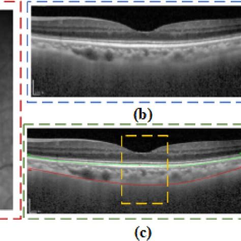 Image result for Oct Retinal Scan Interpretation