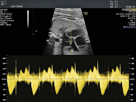 Image result for Normal PR Interval Fetus