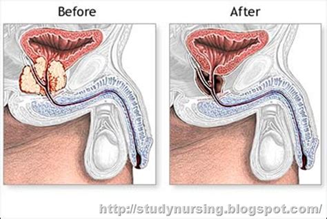 Image result for Post-Prostatectomy