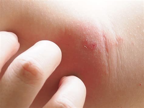 Image result for Bot Fly Larvae Removal