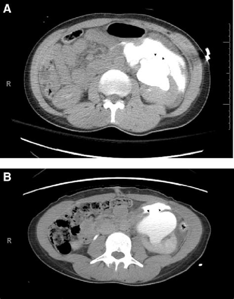 Image result for Delayed Phase CT Urogram