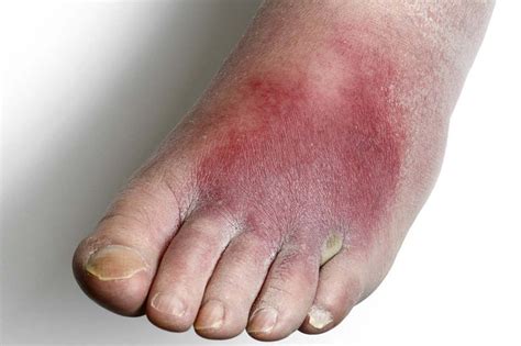 Image result for Cellulitis Toe