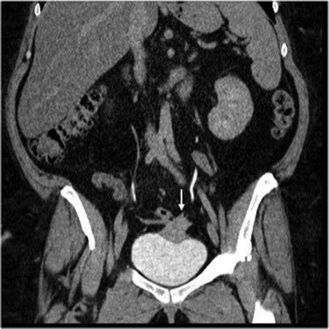 Image result for Volume-Rendered CT Urogram