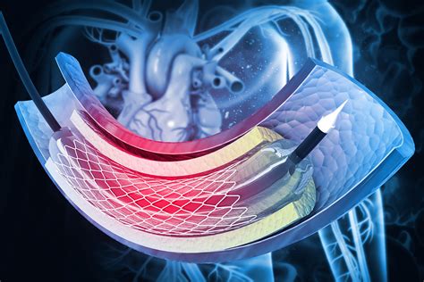 Image result for Different Types of Angiogram
