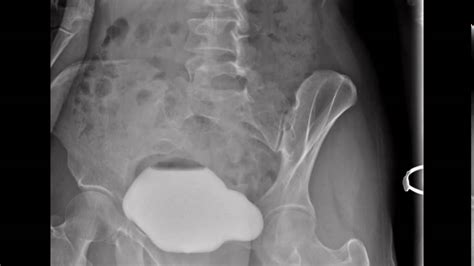 Image result for Cystourethrogram