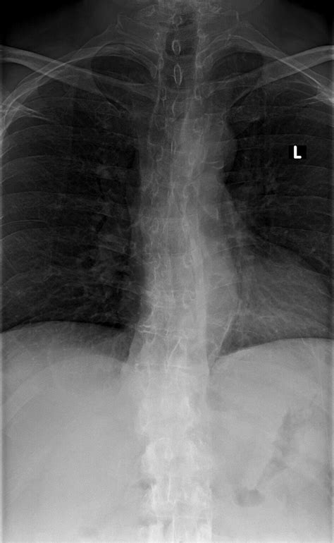 Image result for Surgery for Compression Fracture