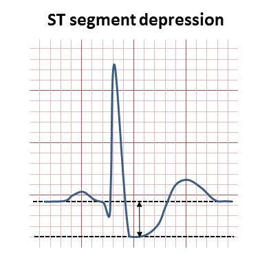 Image result for Types of ST Depression