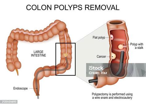 Image result for Control Colonoscopy of Polyps