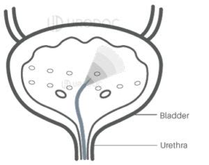 Image result for How Is Botox Injected into the Bladder