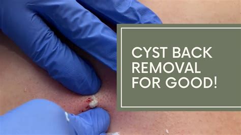 Image result for Upper-Back Cyst Surgery