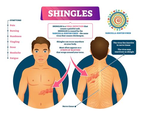 What Are The Stages of Shingles? – Dermeleve®