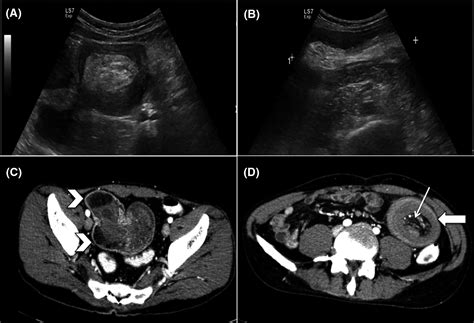 Image result for Intussusception Pseudokidney Sign