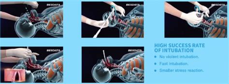 Image result for Watching Intubation