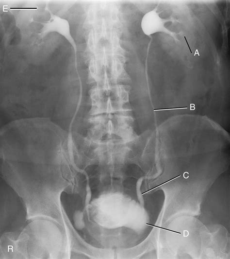 Image result for Urogram Triphasic