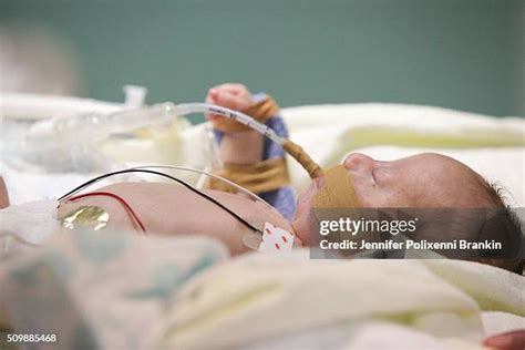 Image result for Neonatal Intubation