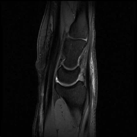 Image result for Wrist Arthrogram