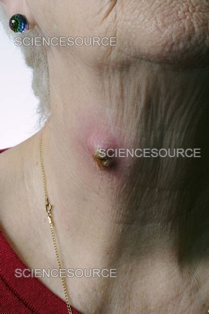 Image result for Big Exploding Cyst Neck