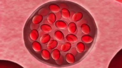 Image result for Sickle Cell Anemia Explained
