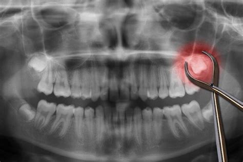 Image result for Wisdom Tooth Upper Right Extraction