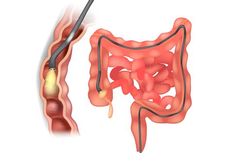 Image result for Normal Bowel Colonoscopy