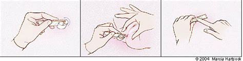 Image result for Pinworm Tape Test Procedure