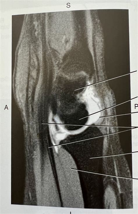 Image result for Wrist Arthrogram