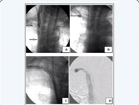 Image result for Angiogram Radial