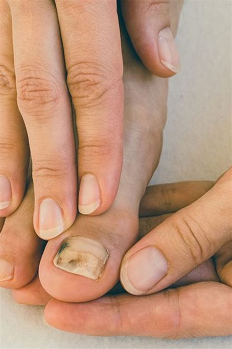 Image result for How to Remove Calluses From Hand