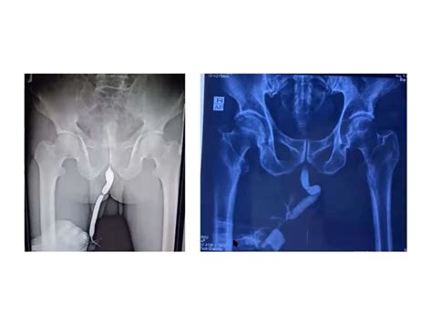 Image result for Urethrogram Procedure