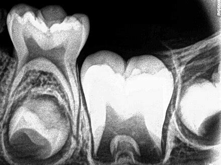 Image result for Tooth Development Video