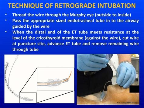 Image result for Retrograde Intubation