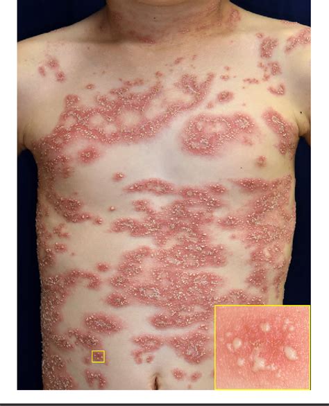 Image result for Types of Pustular Psoriasis