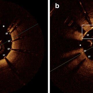Image result for Oct Axial Resolution