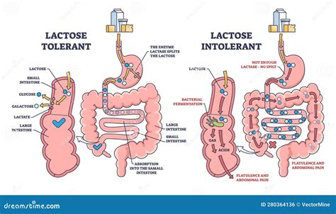 Image result for Lactose Intolerance On Colonoscopy