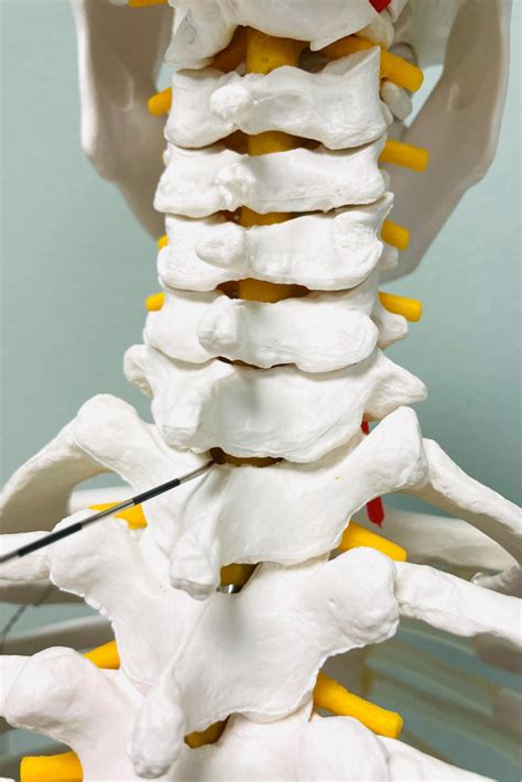 Image result for Cervical Steroid Injection