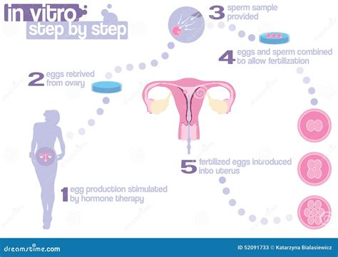 Image result for In Vitro Fertilization Procedure Step by Step