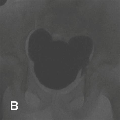 Image result for Voiding Cystourethrogram Image