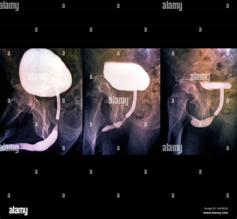 Image result for Voiding Cystourethrogram Image