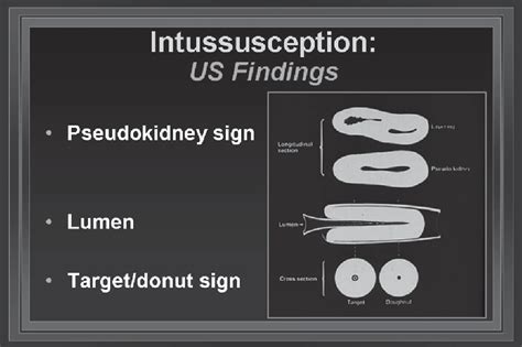 Image result for Intussusception Pseudokidney Sign
